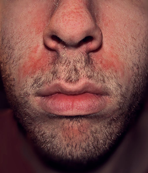 Dermatita Seboreica O Afectiune Cutanata Cronica Dr Mihai Lupu